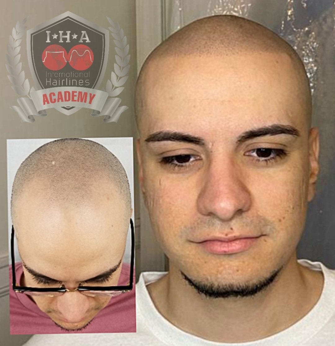 Gallery - Before & After Images of SMP | International Hairlines
