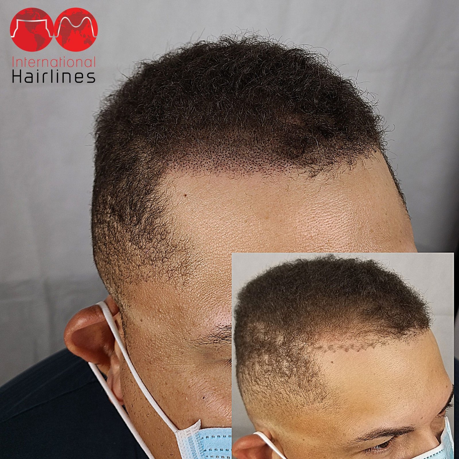 Gallery - Before & After Images of SMP | International Hairlines